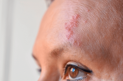 O que é Cobreiro: sintomas, causas, tratamentos e prevenção